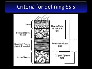 Surgical site infections: Latest Approach on management. | PPTX