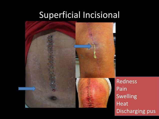 Surgical site infections: Latest Approach on management.