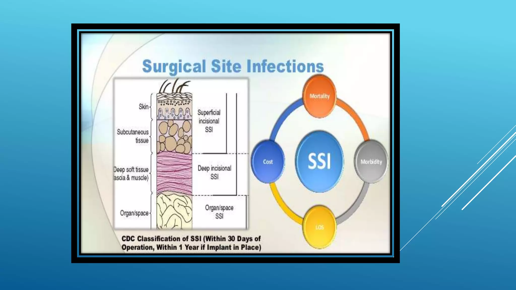 SSI SURGICAL SITE INFECTION | PPT