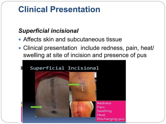 Surgical Site Infections | PPTX