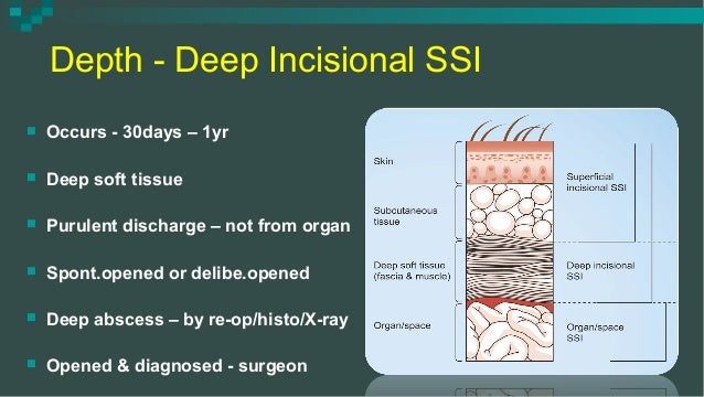 Surgical Site Infection