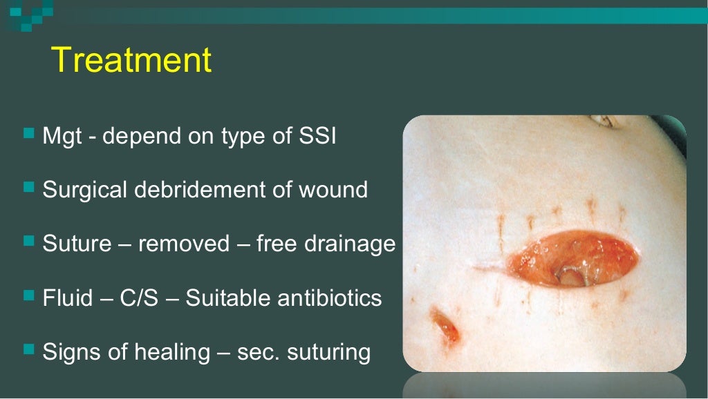 Surgical Site Infection