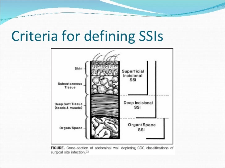 Surgical Site Infection