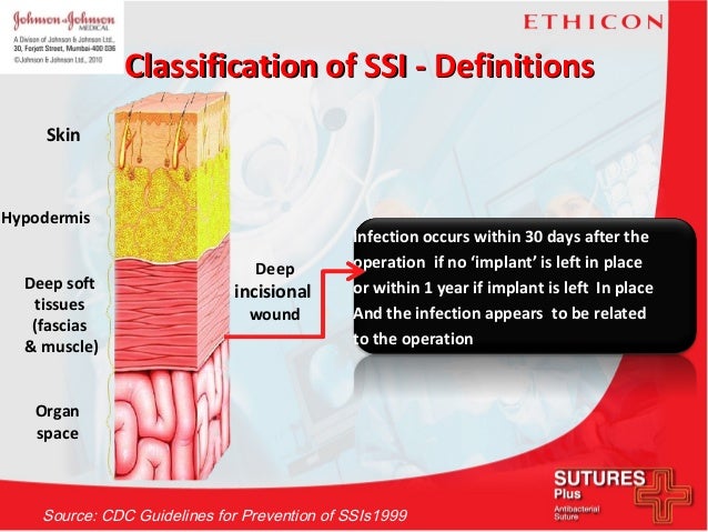 THE IDEAL SURGICAL SUTURE