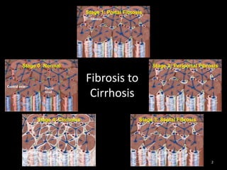 Detecting Early Liver Fibrosis - A Nutshell for Primary Care | PPT