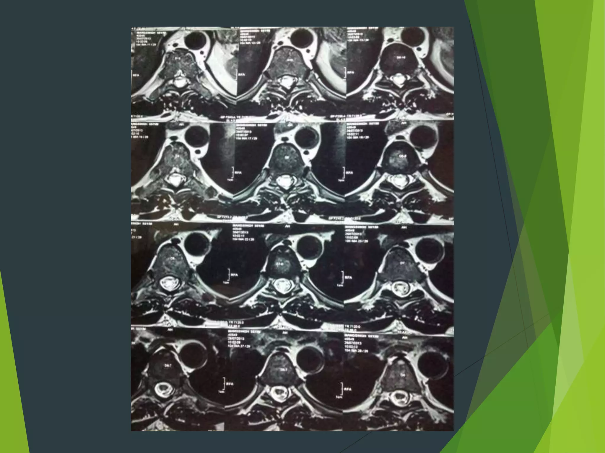 SSPE, myasthenia n LETM | PPTX