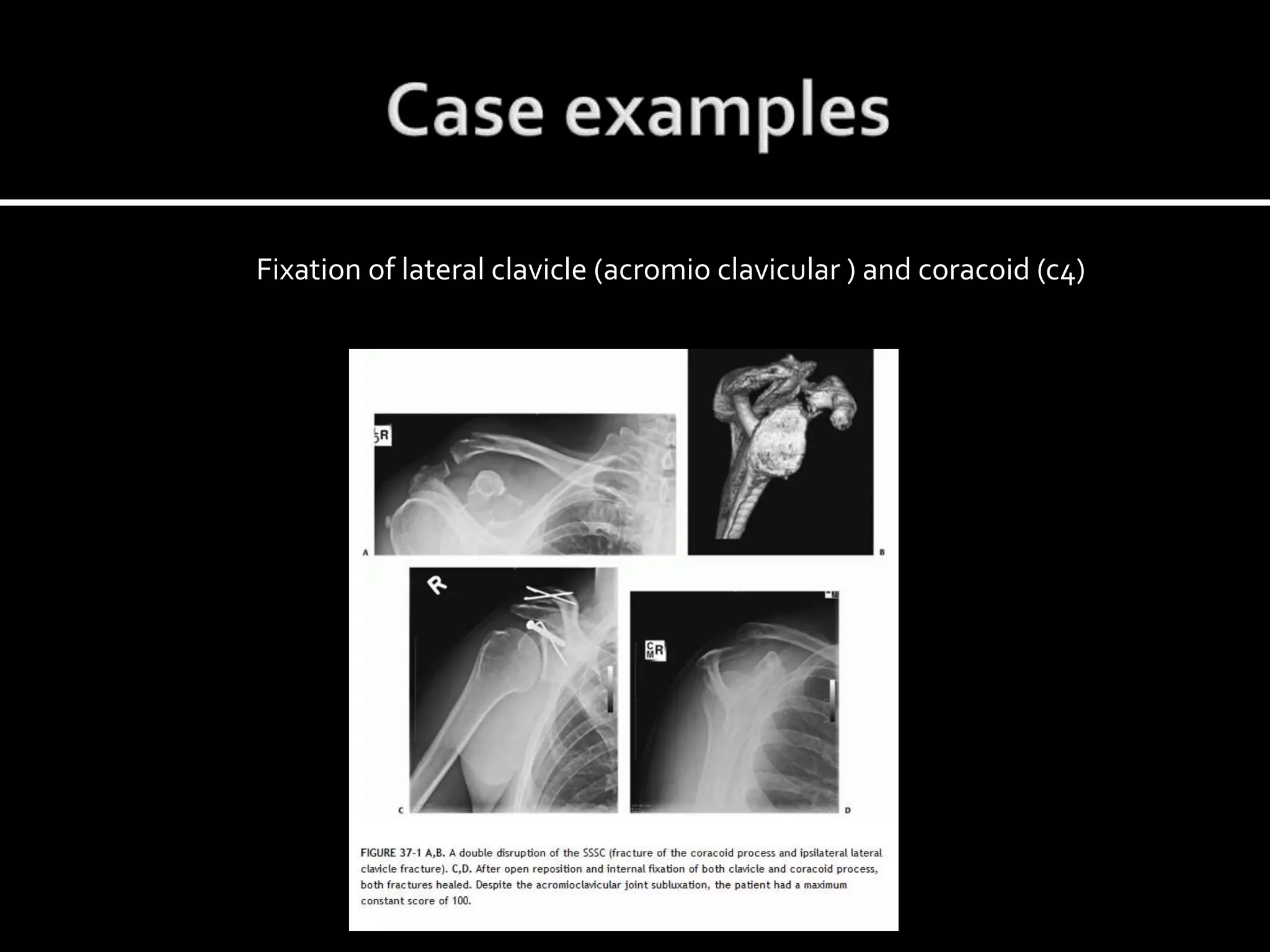 Superior Shoulder Suspensory Complex injuries (SSSC) | PPTX