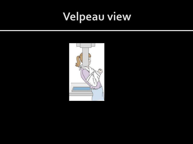 Superior Shoulder Suspensory Complex injuries (SSSC) | PPTX