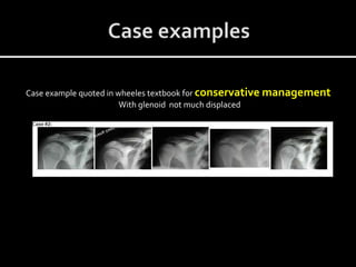 Superior Shoulder Suspensory Complex injuries (SSSC) | PPTX