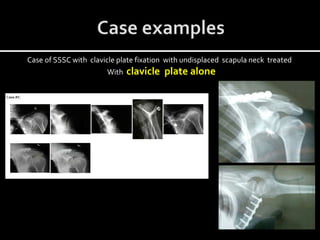 Superior Shoulder Suspensory Complex injuries (SSSC) | PPTX