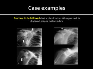 Superior Shoulder Suspensory Complex injuries (SSSC) | PPTX