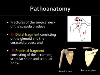 Superior Shoulder Suspensory Complex injuries (SSSC) | PPTX