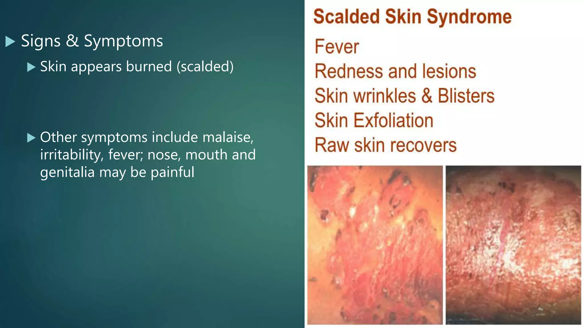 skin and soft tissue infection paediatric | PPTX