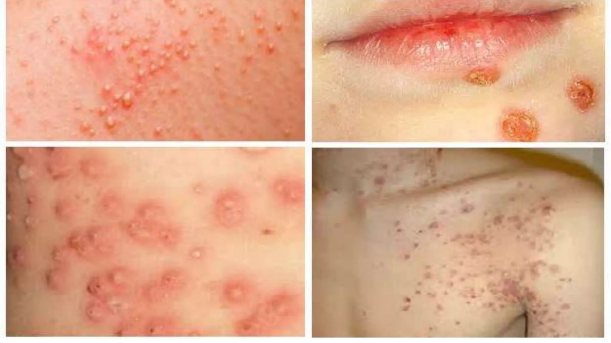 skin and soft tissue infection paediatric | PPTX