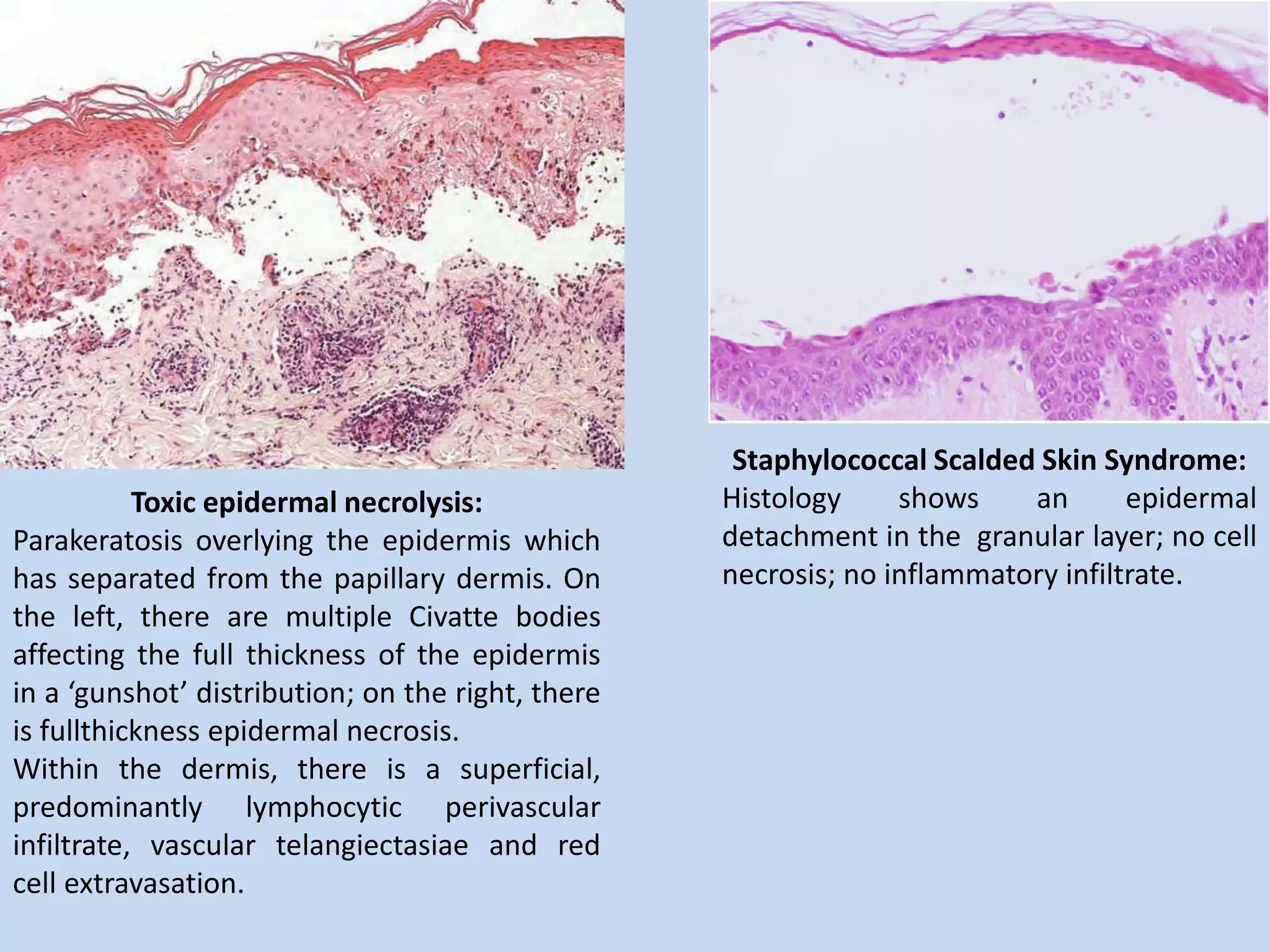 Staphylococcal Scalded Skin Syndrome Made Very Easy | PPTX