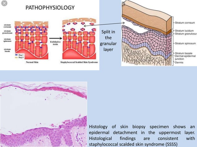 Staphylococcal Scalded Skin Syndrome Made Very Easy | PPTX