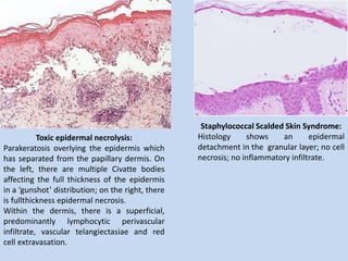 Staphylococcal Scalded Skin Syndrome Histology