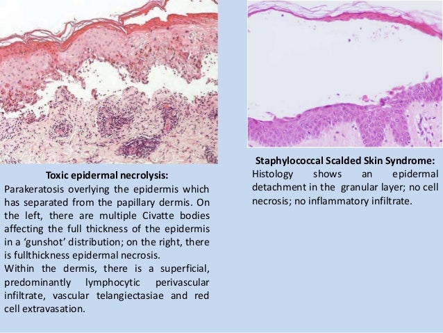 Staphylococcal Scalded Skin Syndrome Made Very Easy