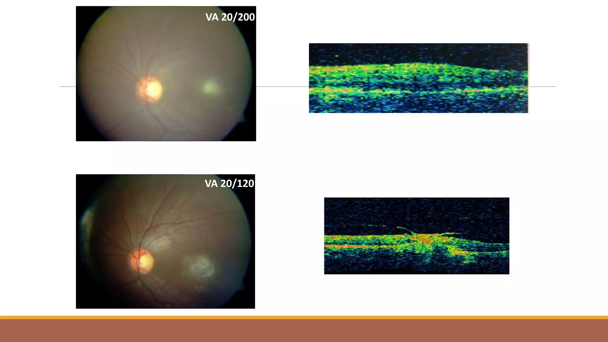 Uveitis: Workup and Management | PPTX