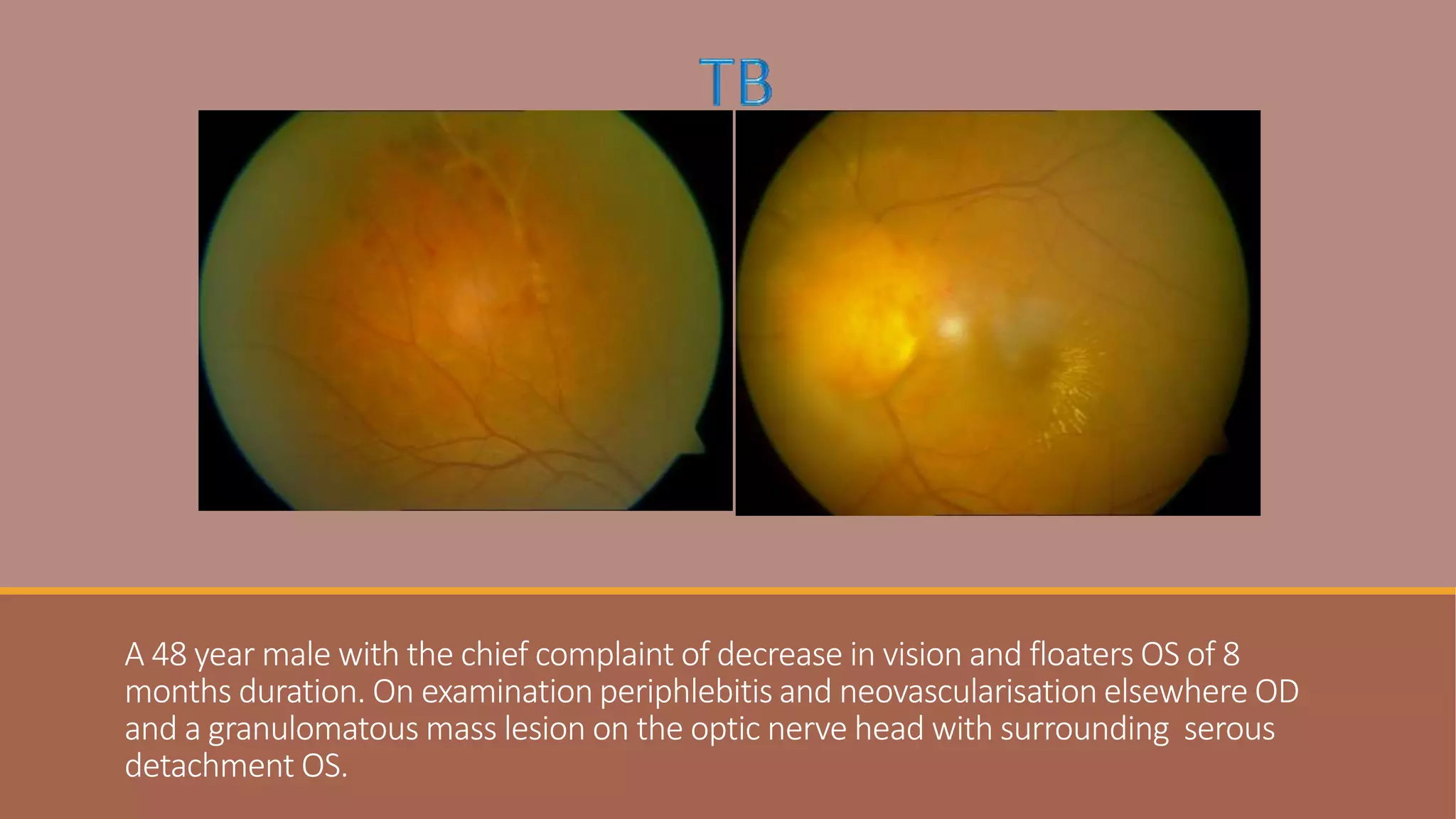 Uveitis: Workup and Management | PPTX