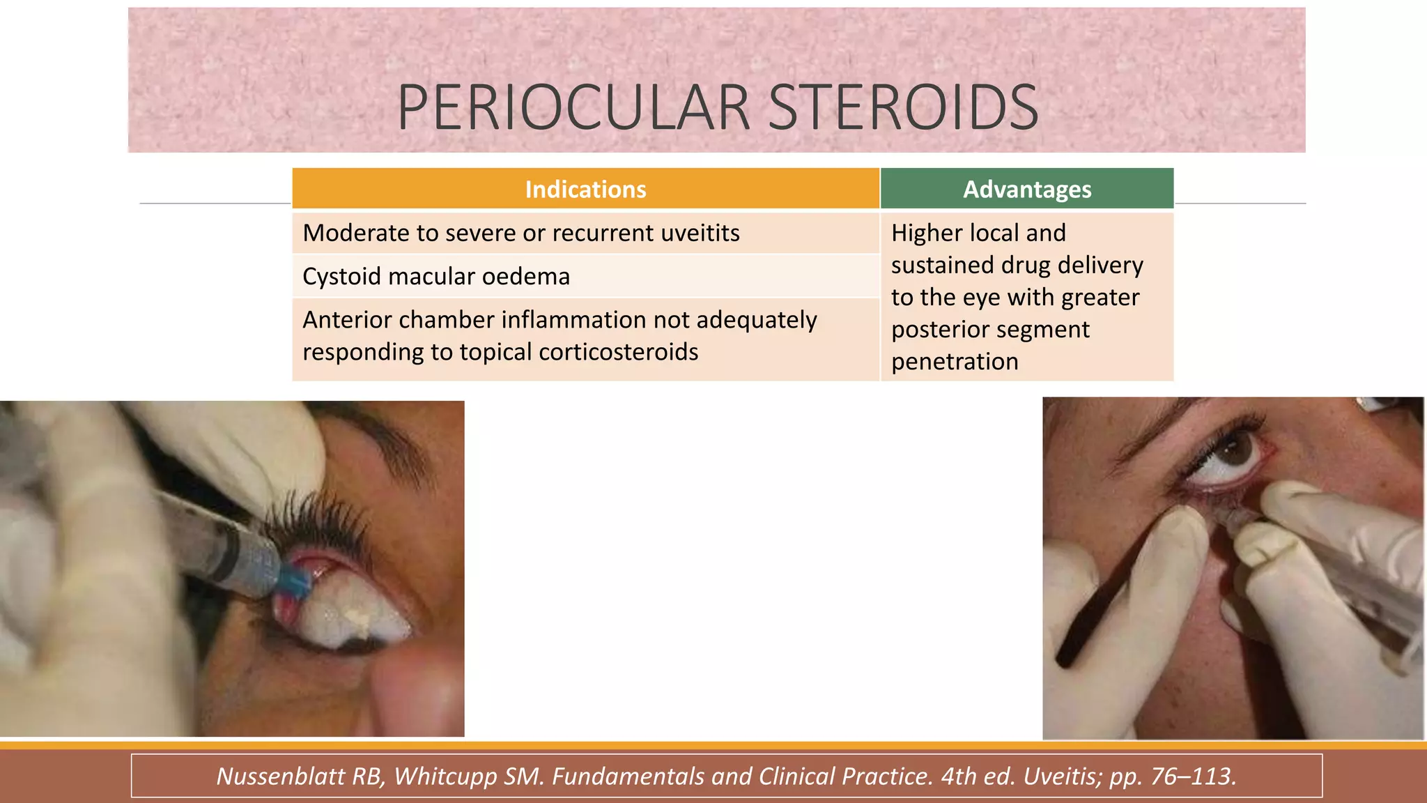 Uveitis: Workup and Management | PPTX