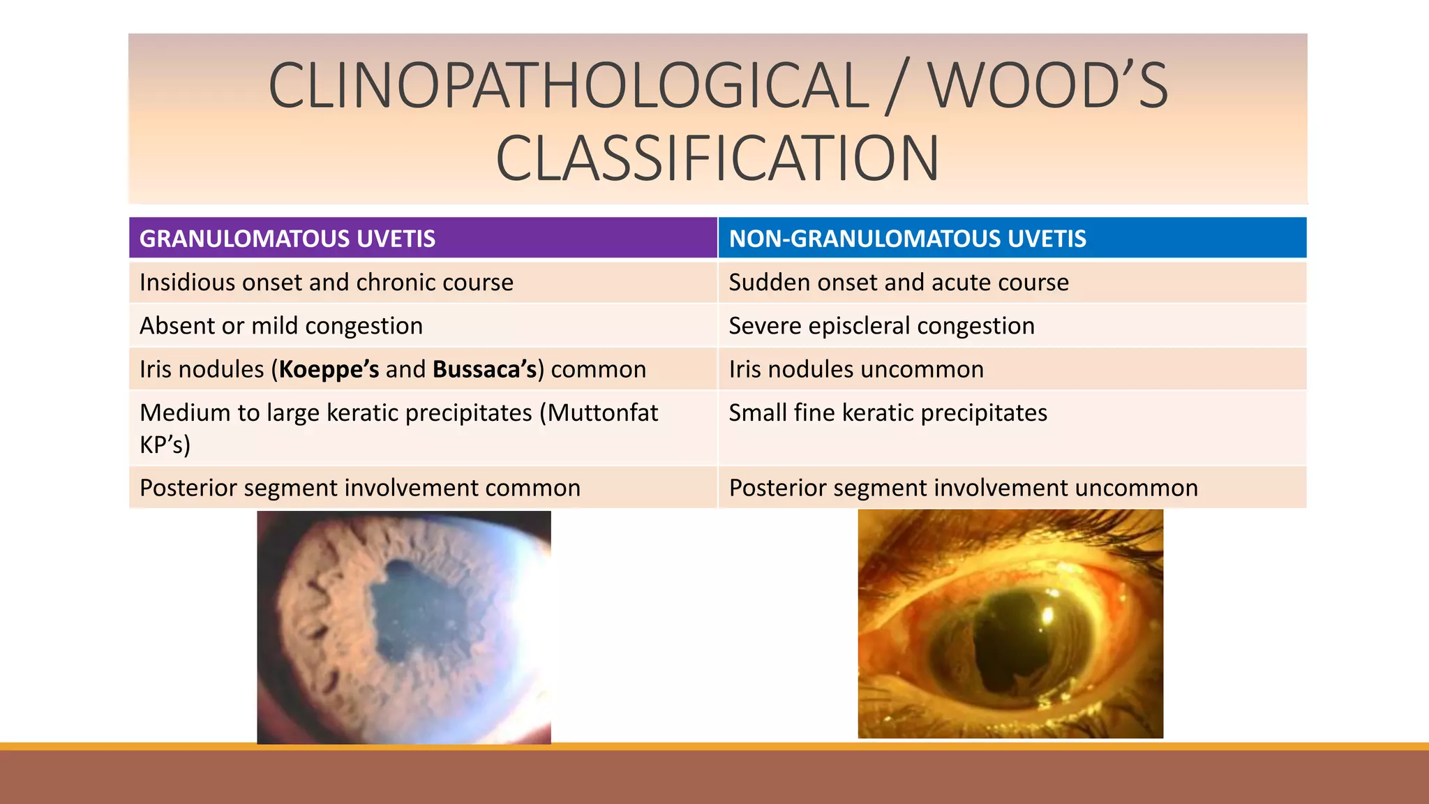 Uveitis: Workup and Management | PPTX