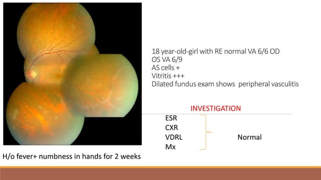 Uveitis: Workup and Management | PPTX | Eye and Vision Conditions ...