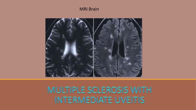 Uveitis: Workup and Management | PPTX | Eye and Vision Conditions ...