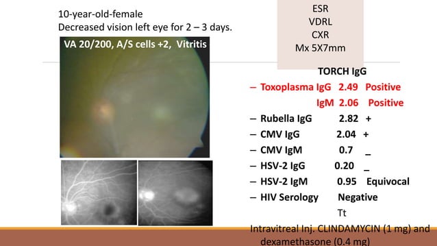 Uveitis: Workup and Management | PPTX | Eye and Vision Conditions ...