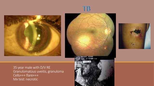 Uveitis: Workup and Management | PPTX | Eye and Vision Conditions ...