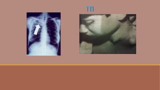 Uveitis: Workup and Management | PPTX