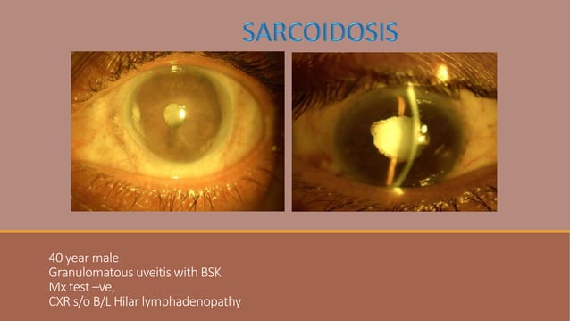 Uveitis: Workup and Management | PPTX | Eye and Vision Conditions ...