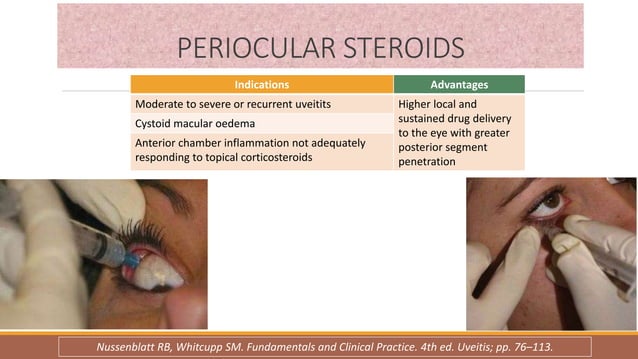 Uveitis: Workup and Management | PPTX | Eye and Vision Conditions ...