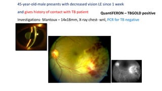 Uveitis: Workup and Management | PPTX