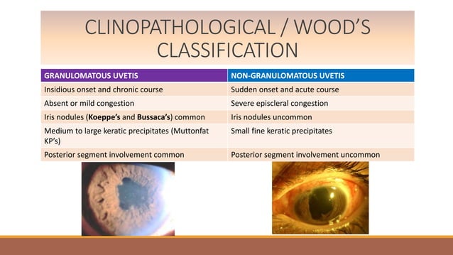 Uveitis: Workup and Management | PPTX | Eye and Vision Conditions ...