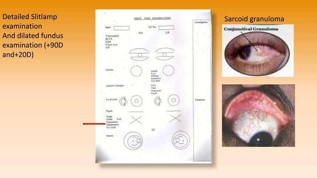 Uveitis: Workup and Management | PPTX | Eye and Vision Conditions ...