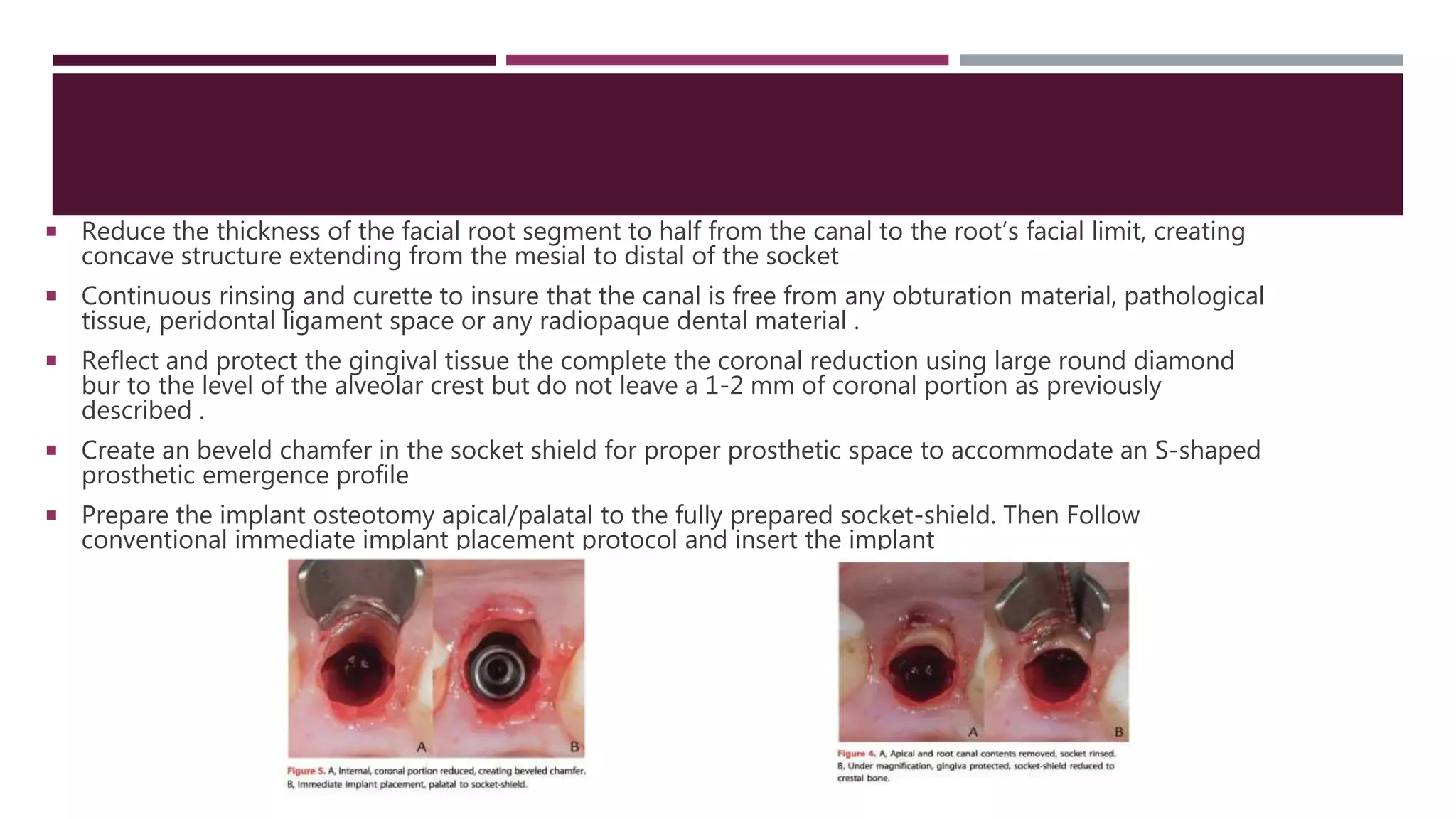 Prosthetic management of implant placed with socket-shield technique | PPTX