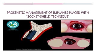 Prosthetic management of implant placed with socket-shield technique | PPTX | Dental Health ...