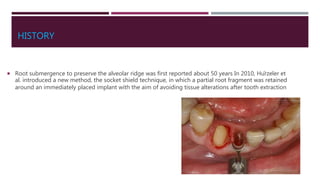 Prosthetic management of implant placed with socket-shield technique ...