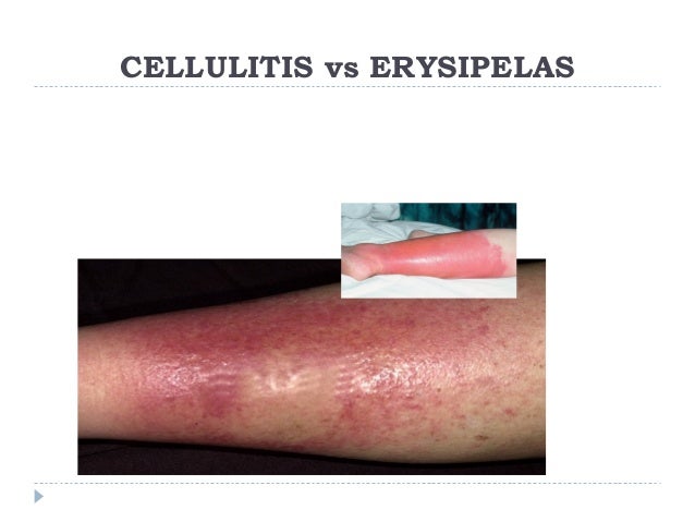 Erysipelas Vs Cellulitis Vs Impetigo