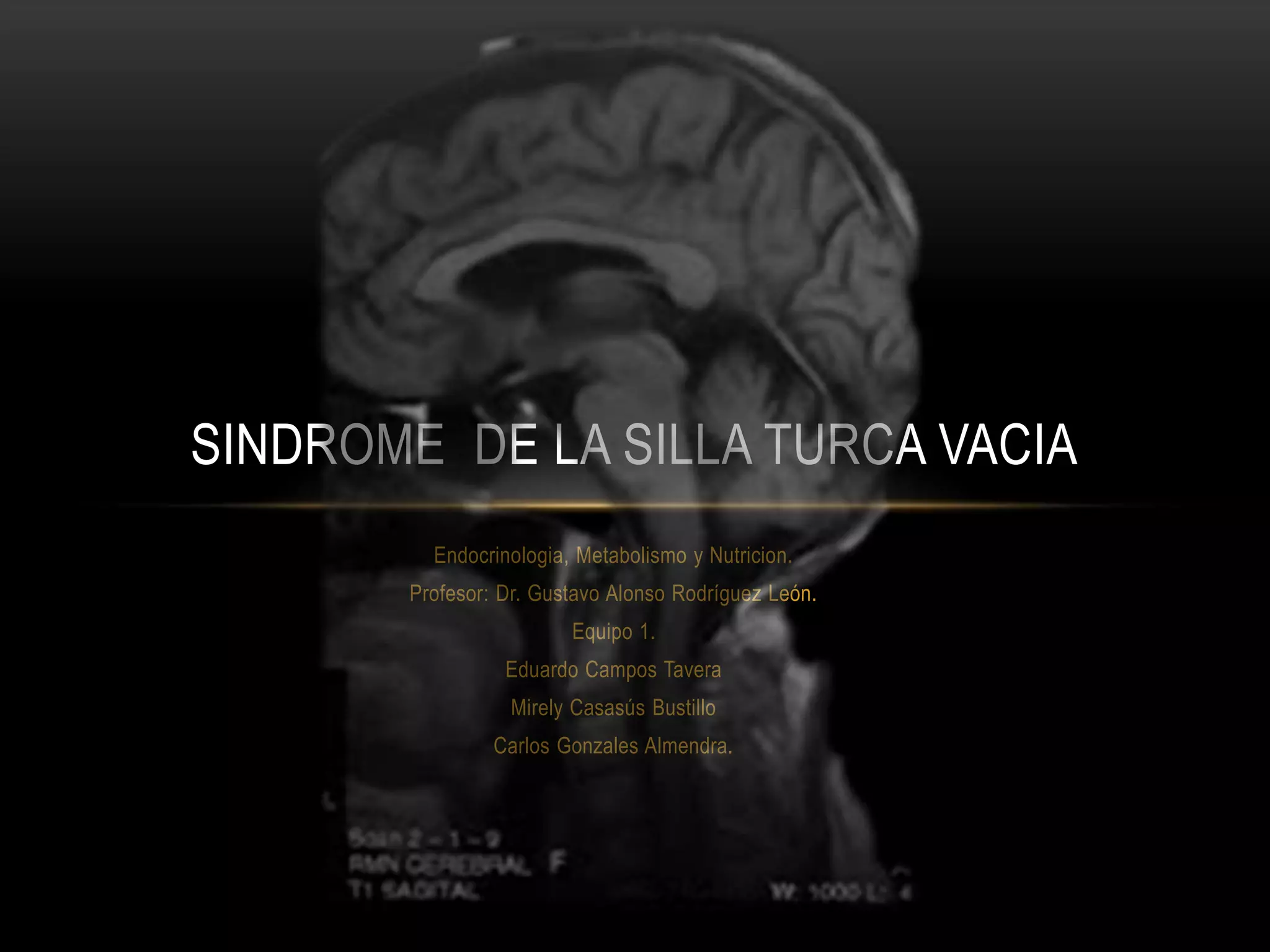 Sindrome de La Silla Turca Vacia. (EMPTY SELLA SYNDROME) | PPTX