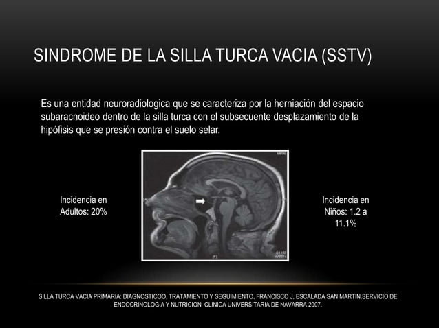Sindrome de La Silla Turca Vacia. (EMPTY SELLA SYNDROME)