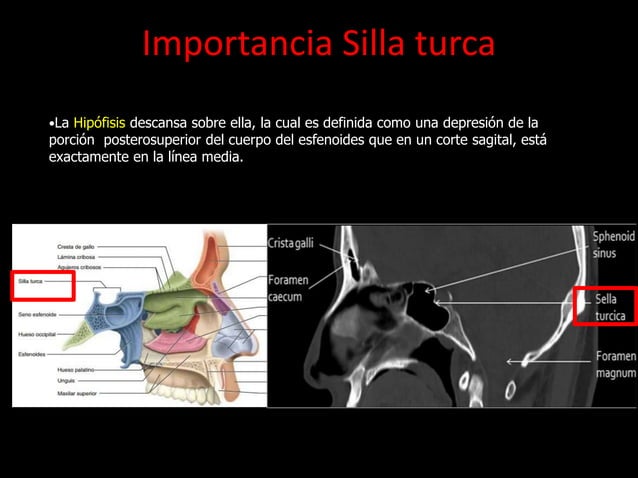 Síndrome Silla Turca Vacía | PPT | Descarga Gratuita