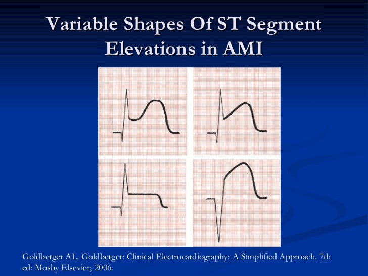 ST Segment Elevations in ECG