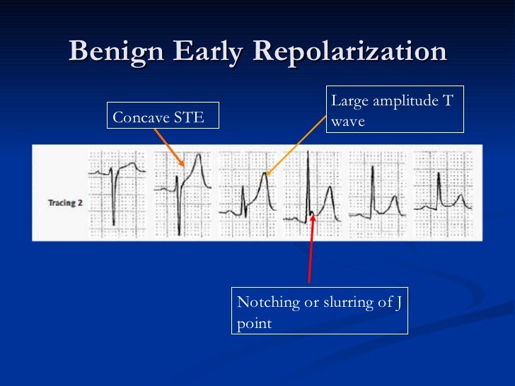 ST Segment Elevations in ECG