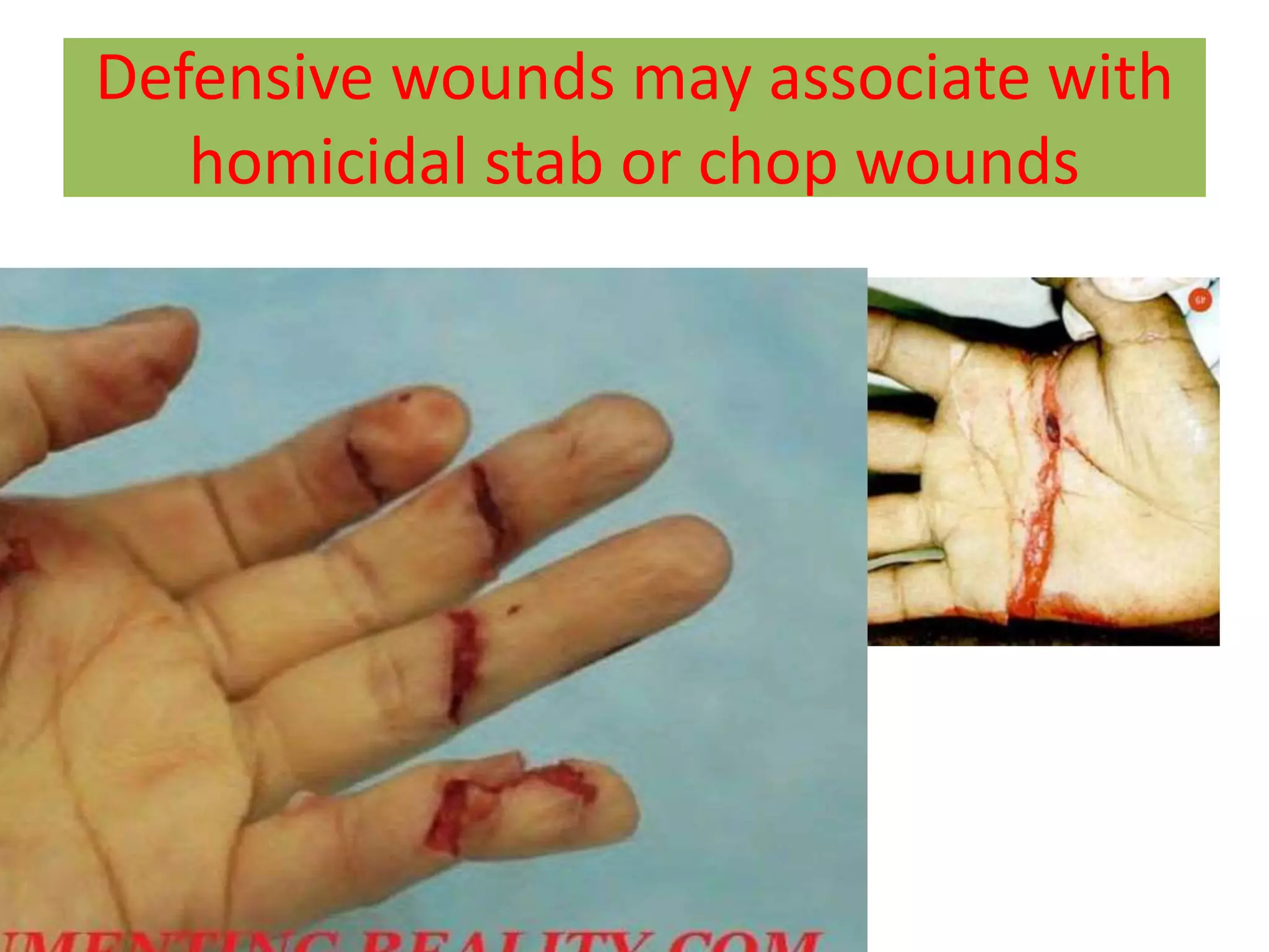 Stab and chop wounds mb singh 2020 | PPTX