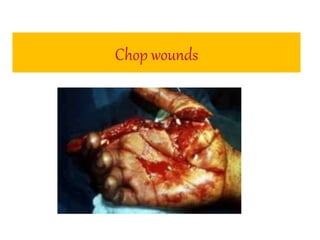 Stab and chop wounds mb singh 2020 | PPTX