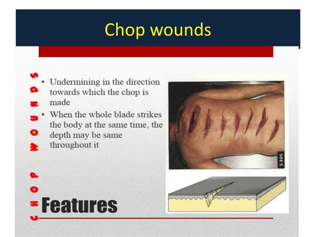 Stab and chop wounds mb singh 2020 | PPTX | First Aid | Injuries