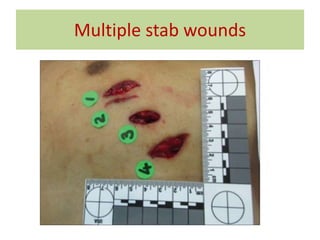 Stab and chop wounds mb singh 2020 | PPTX