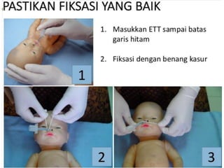 STABILISASI PASCA RESUSITASI NEONATUS.pptx